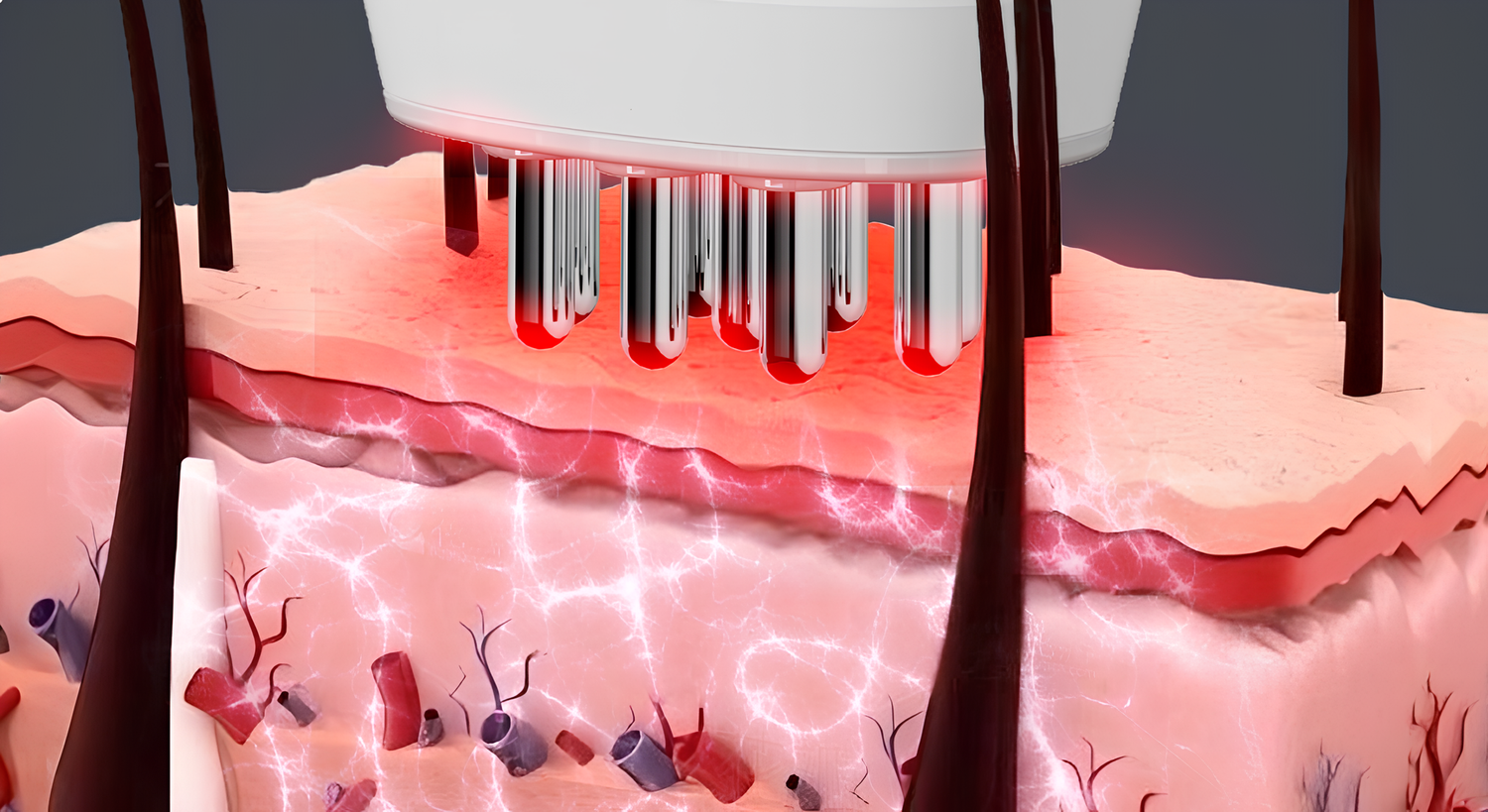 Electric Minoxidil Atomizer – Morfone